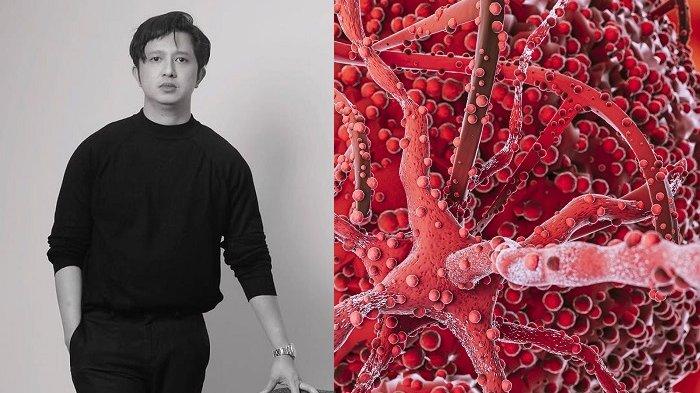 Kenali Gejala Aneurisma Otak, Sakit Dikeluhknan Dokter Azmi Sebelum ...